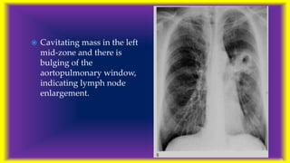Radiological features of Lung cancer Dr. Muhammad Bin Zulfiqar | PPTX
