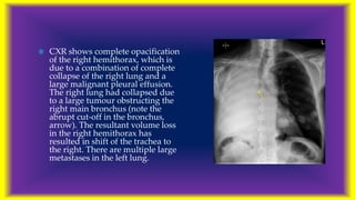 Radiological features of Lung cancer Dr. Muhammad Bin Zulfiqar | PPTX