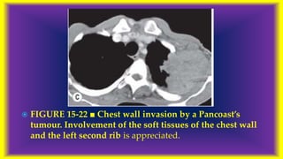 Radiological features of Lung cancer Dr. Muhammad Bin Zulfiqar | PPTX