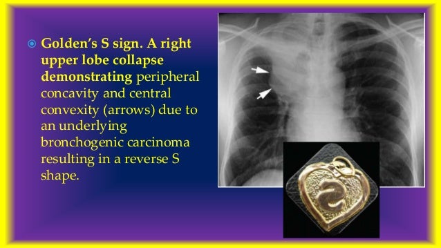 Radiological features of Lung cancer Dr. Muhammad Bin Zulfiqar