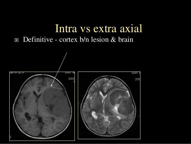 Radiological features of intracranial tumors 1
