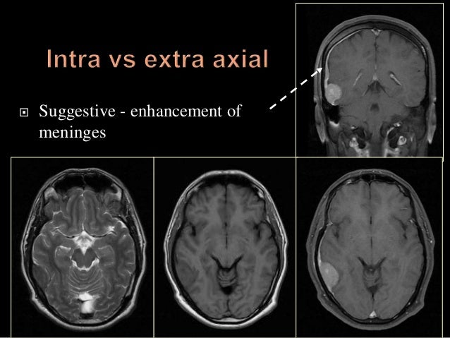 Radiological features of intracranial tumors 1