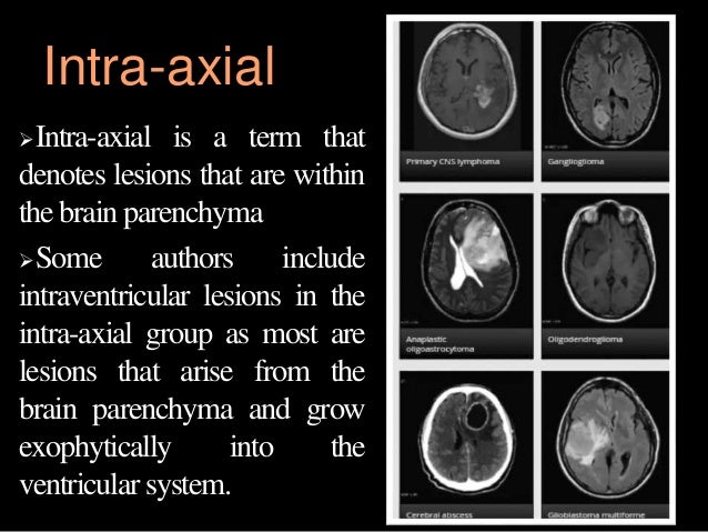 Radiological features of intracranial tumors 1
