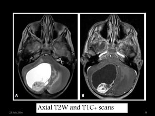 Radiological features of intracranial tumors 2 | PPTX