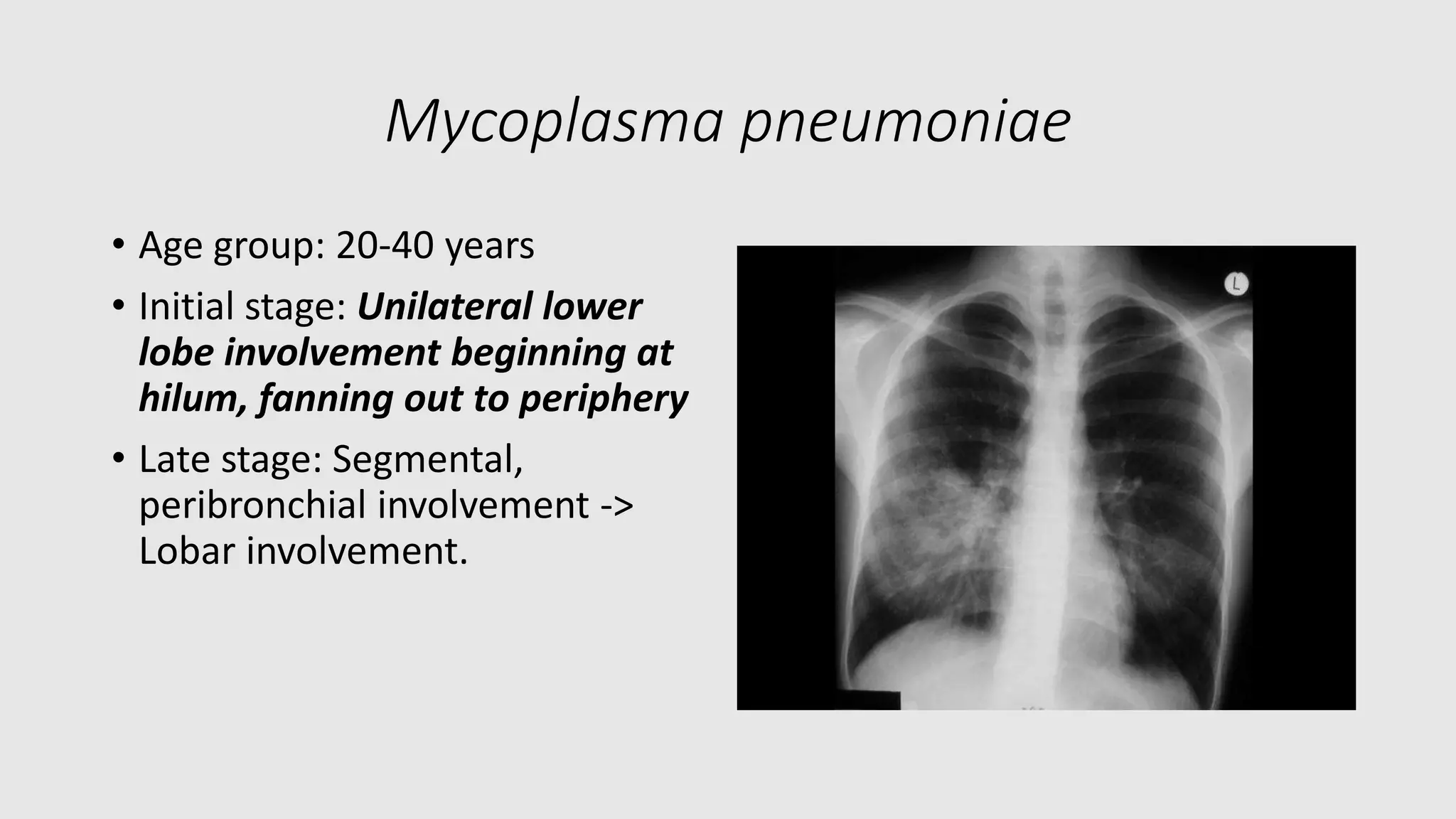 Radiological features of pneumonia | PPTX