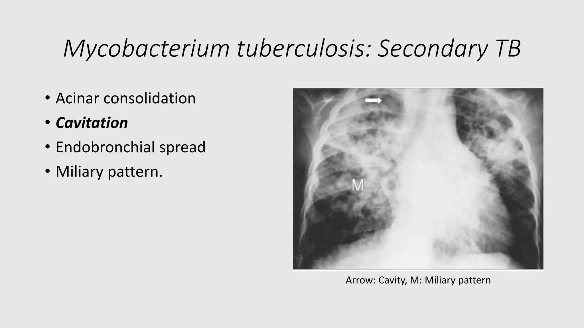 Radiological features of pneumonia | PPTX