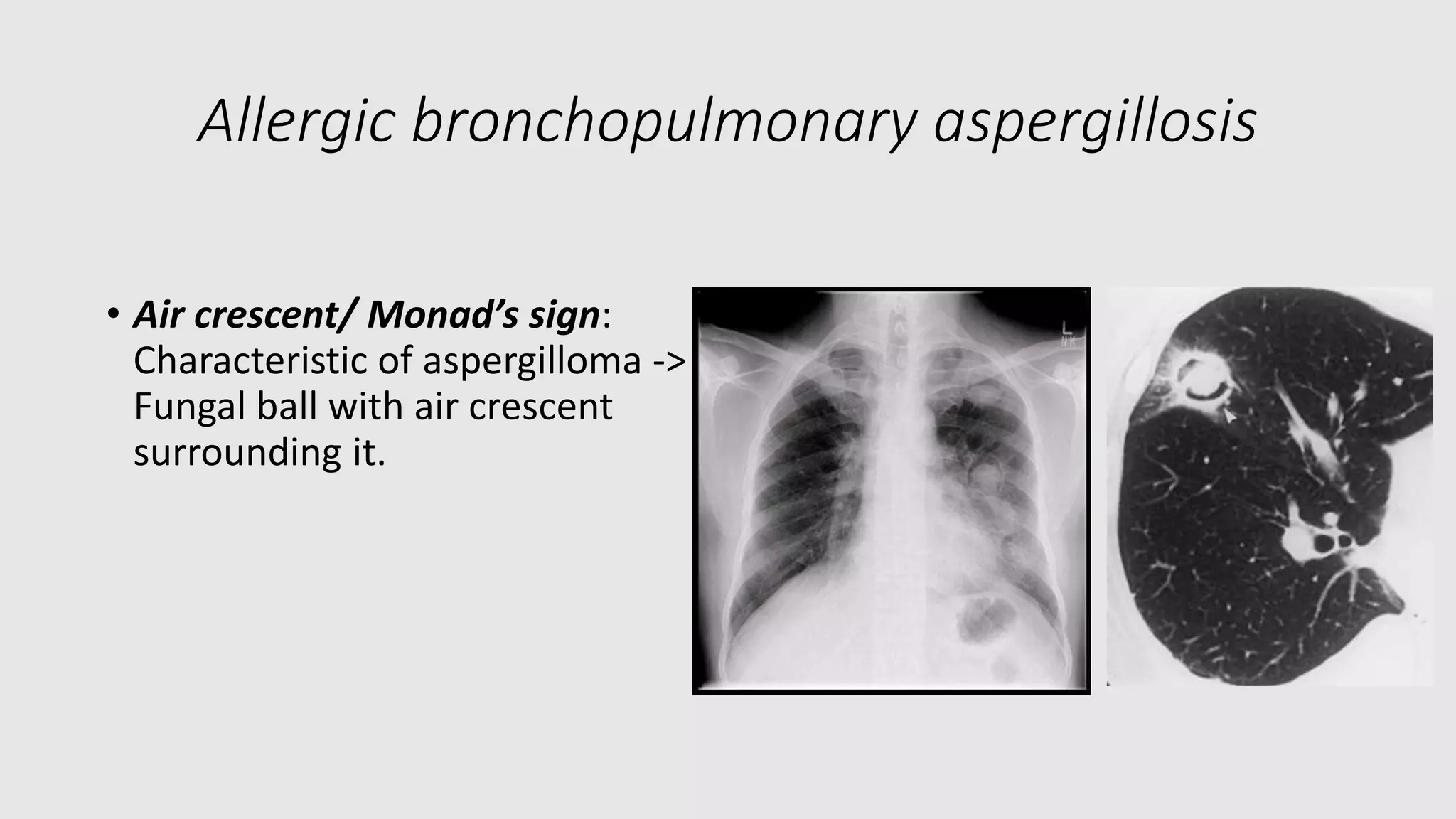 Radiological features of pneumonia | PPTX