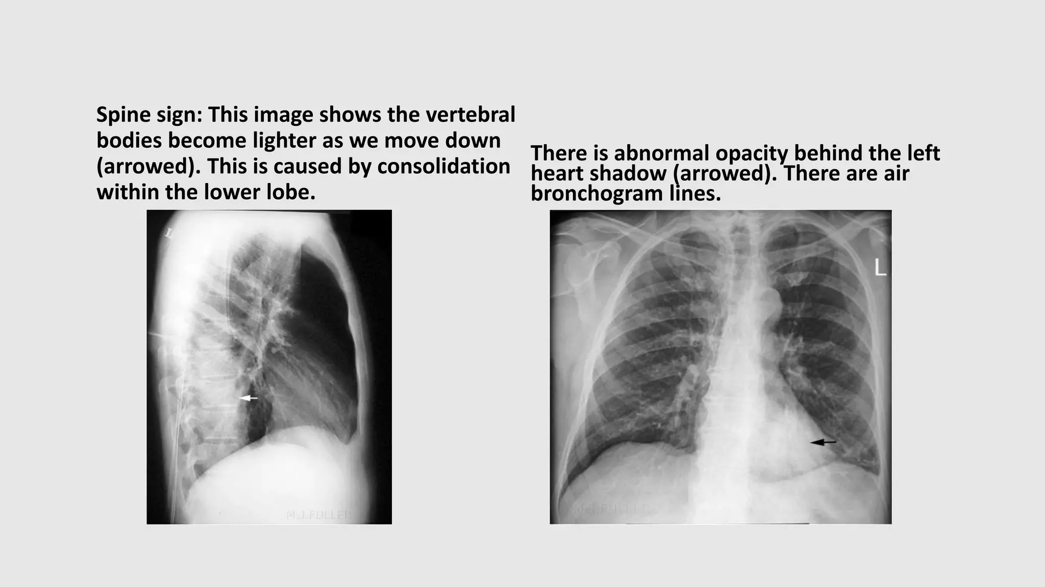 Radiological features of pneumonia | PPTX