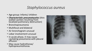 Radiological features of pneumonia | PPTX