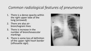 Klebsiella Pneumoniae X Ray