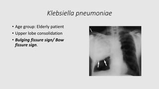 Klebsiella Pneumoniae X Ray