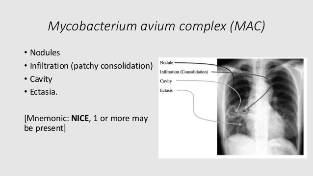 Radiological features of pneumonia