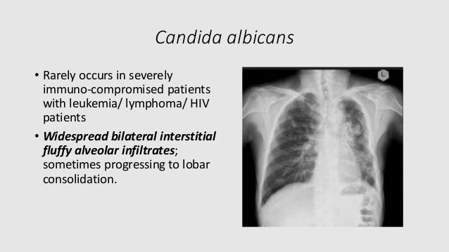 Radiological features of pneumonia