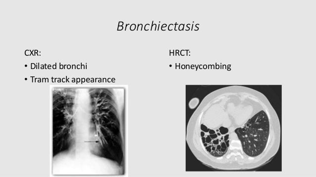 Radiological features of pneumonia