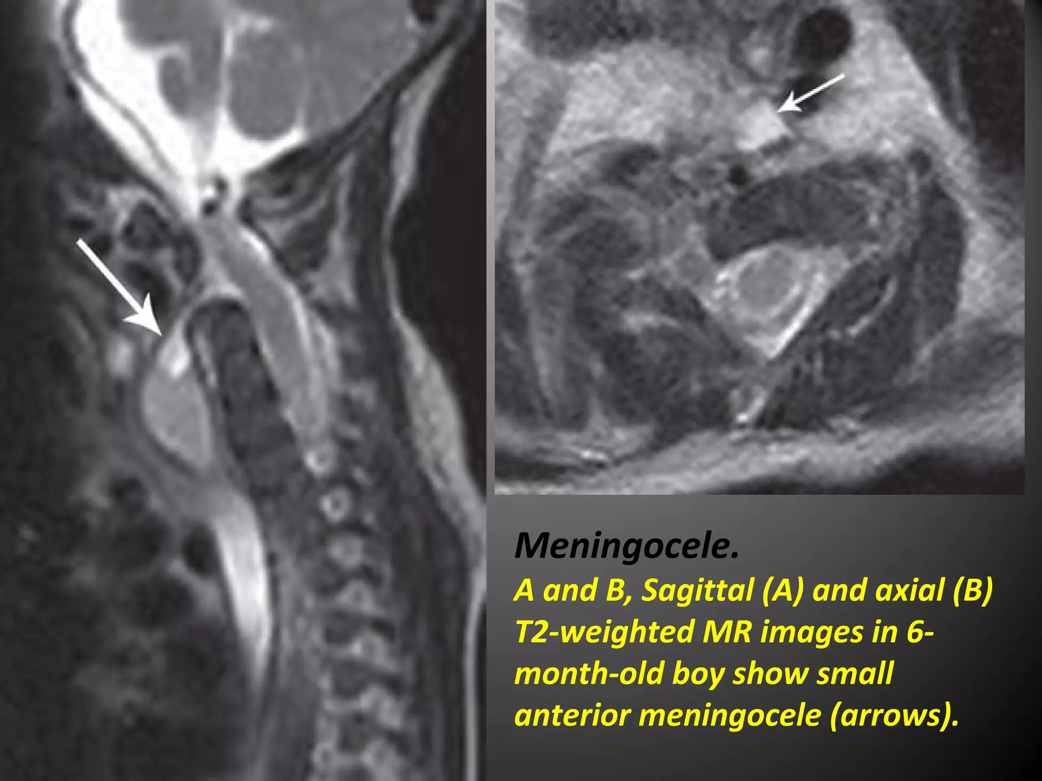 Radiological findings of congenital anomalies of the spine and spinal ...