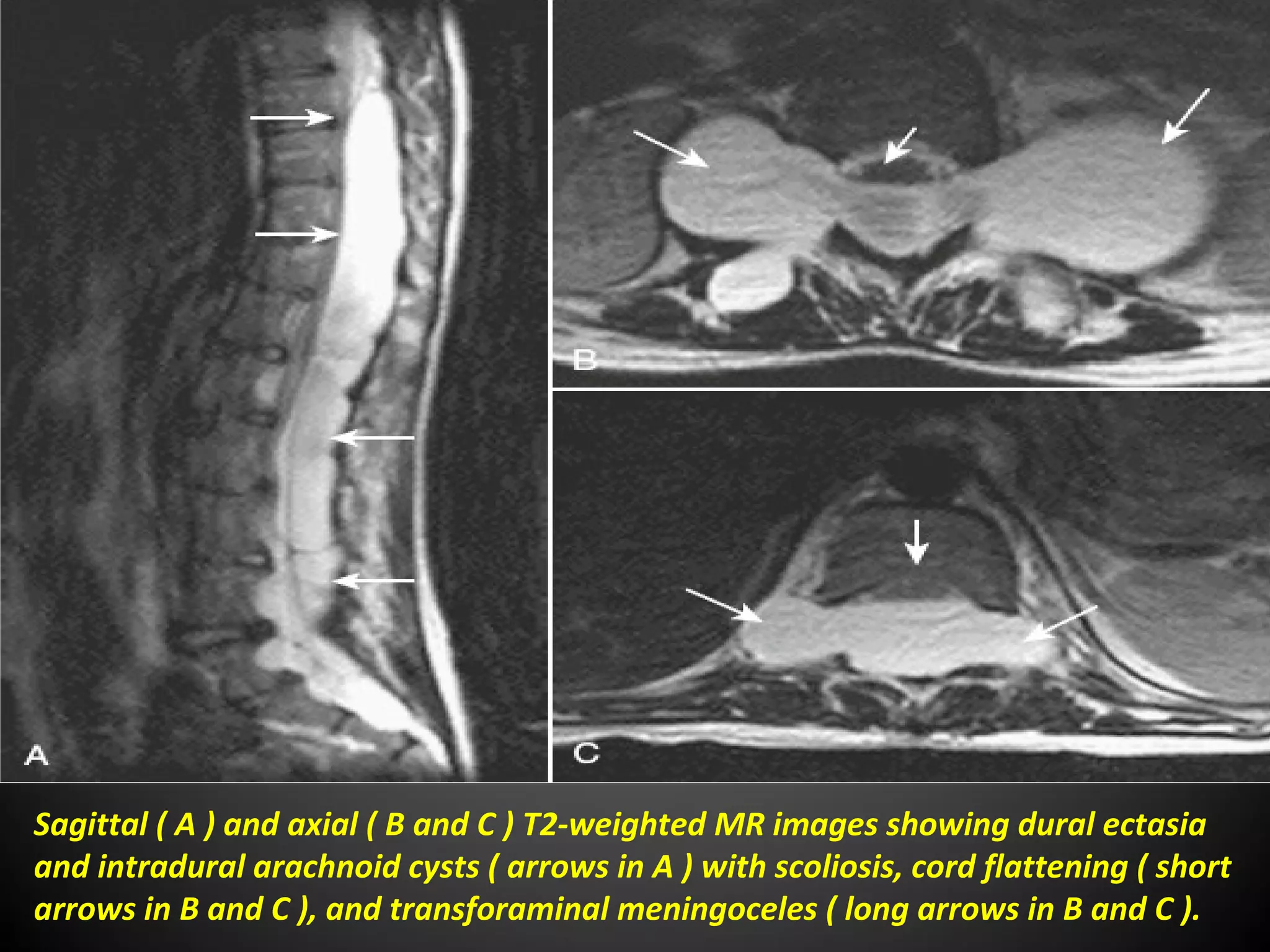 Radiological findings of congenital anomalies of the spine and spinal ...