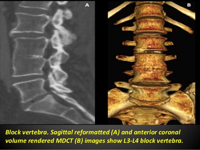 Radiological findings of congenital anomalies of the spine and spinal…