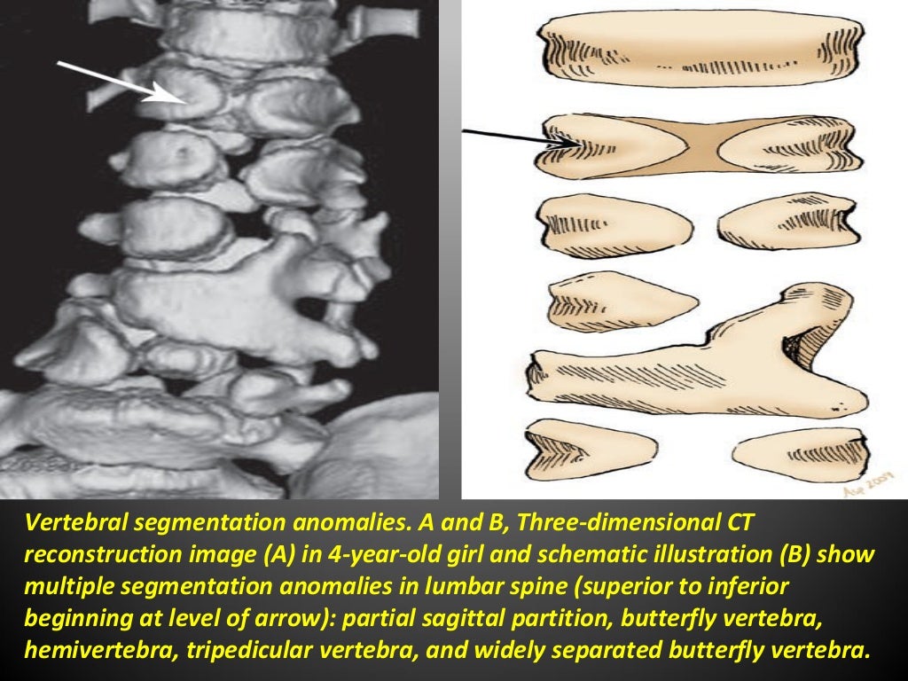 Radiological findings of congenital anomalies of the spine and spinal…