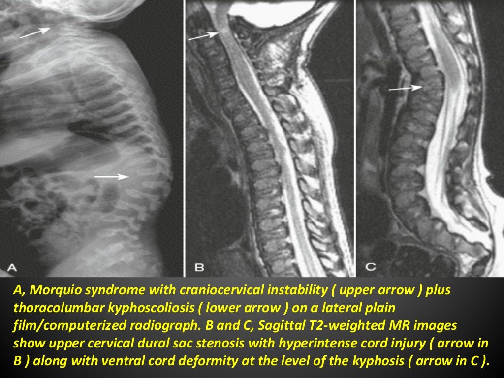 Radiological findings of congenital anomalies of the spine and spinal…