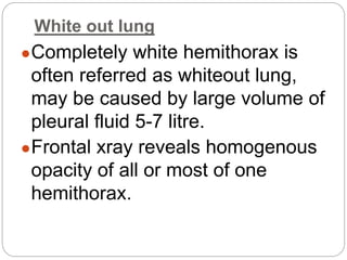 Radiological findings of pleural effussion | PPT