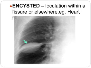 Radiological findings of pleural effussion | PPT
