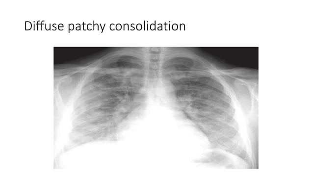 Radiological findings of pulmonary consolidation and collapse | PPTX