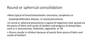 Radiological findings of pulmonary consolidation and collapse | PPTX