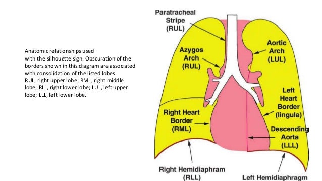 Radiological findings of pulmonary consolidation and collapse