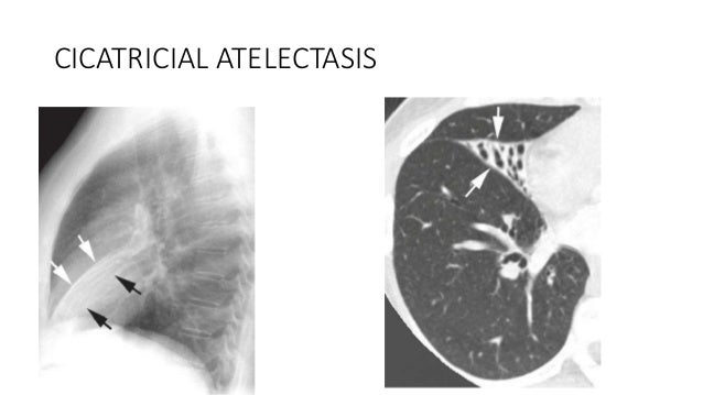 Radiological findings of pulmonary consolidation and collapse
