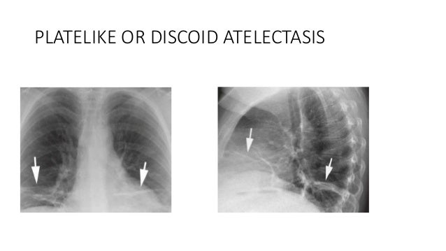 Radiological findings of pulmonary consolidation and collapse