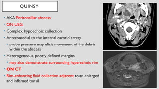 RADIOLOGICAL IMAGING INORO AND NASOPHARYNX AND ITS PATHOLOGIES.pptx