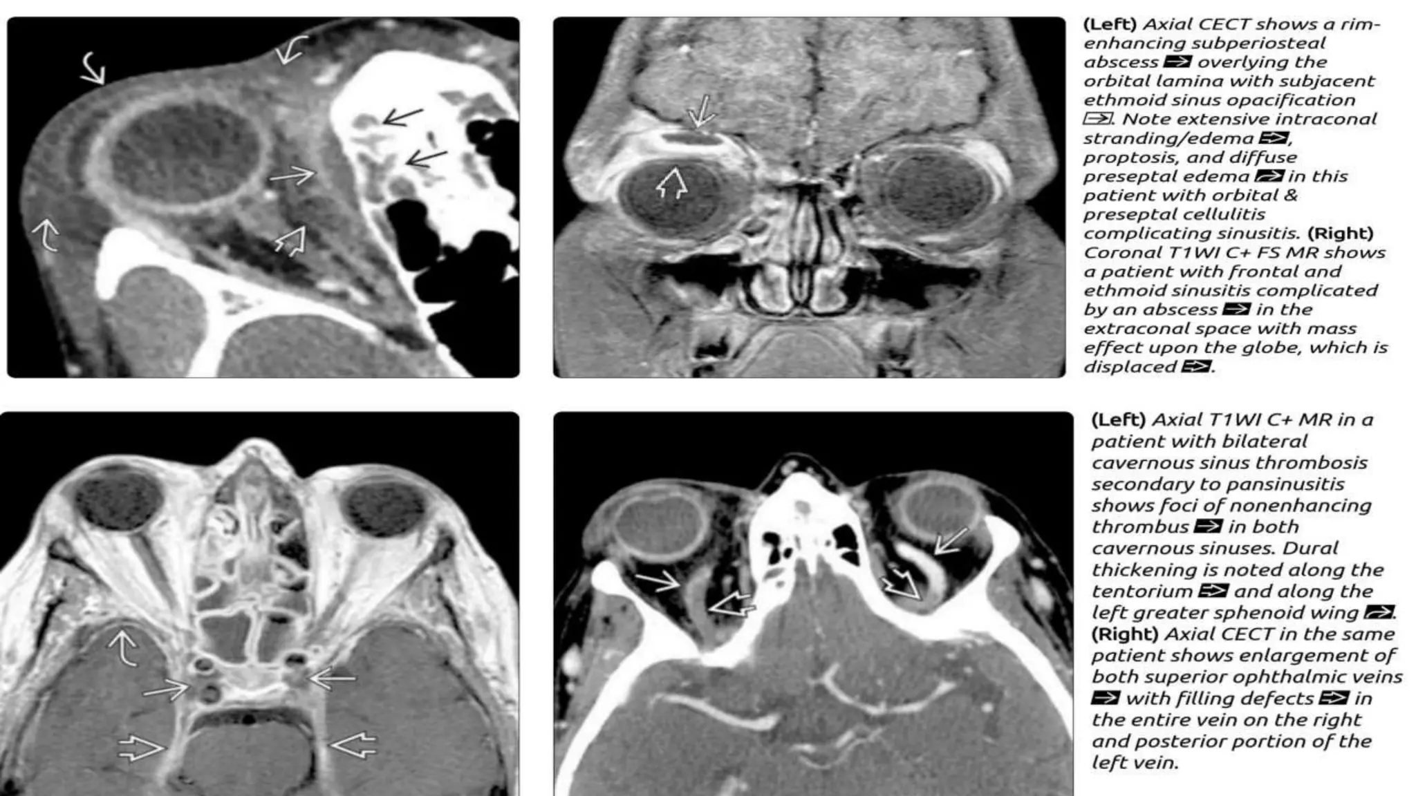 Radiological imaging in sinusitis.pptx
