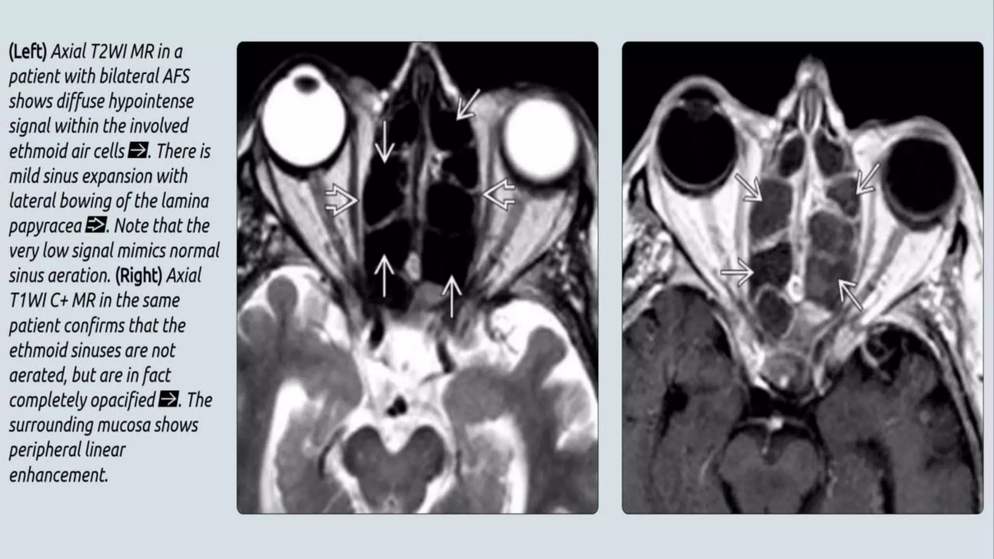 Radiological imaging in sinusitis.pptx