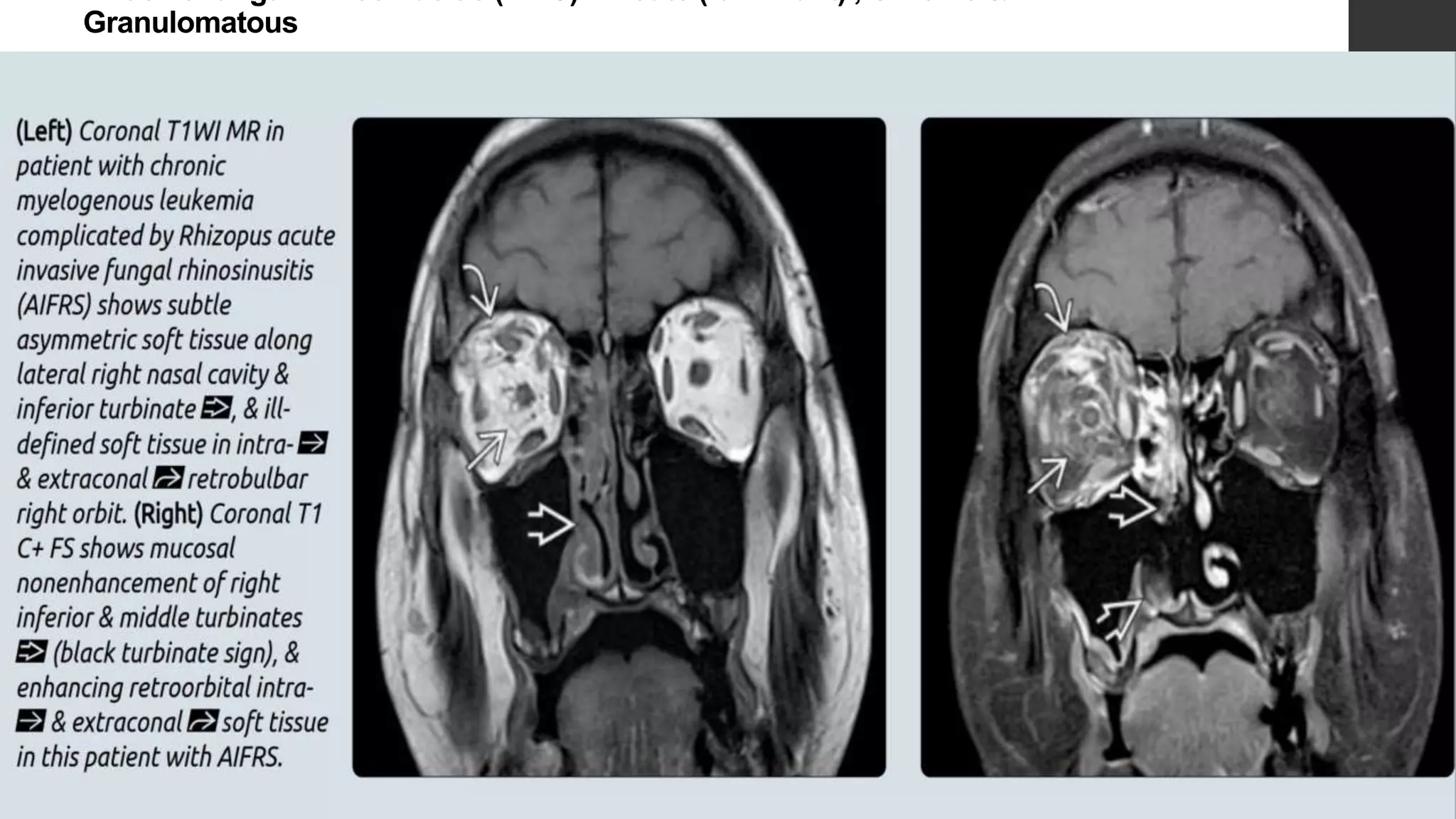 Radiological imaging in sinusitis.pptx