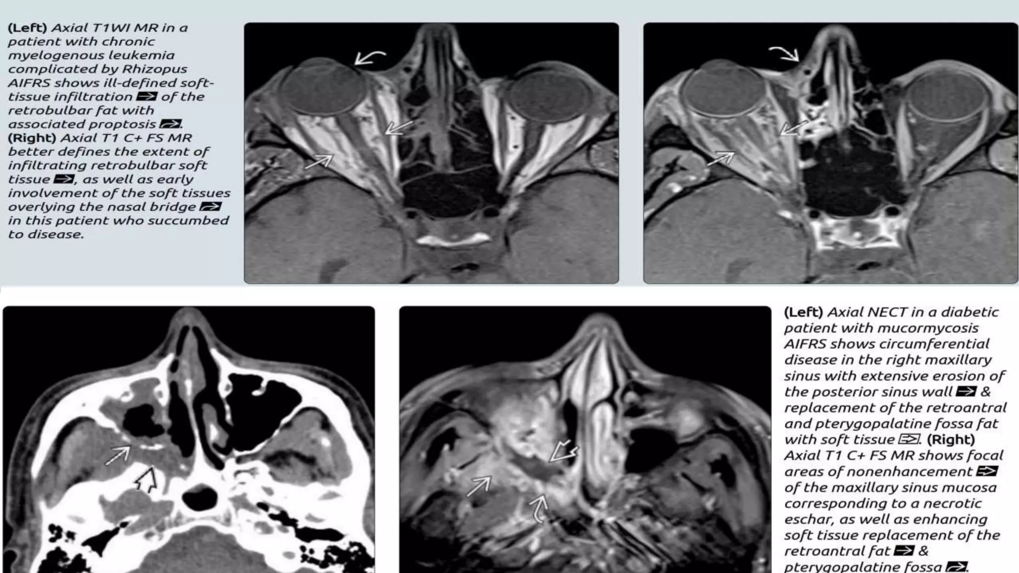 Radiological imaging in sinusitis.pptx