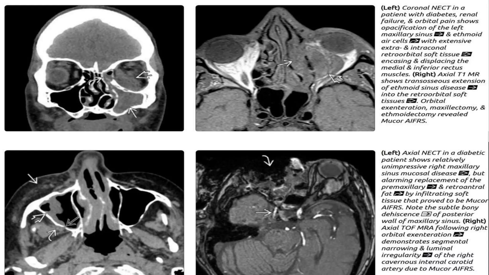 Radiological imaging in sinusitis.pptx