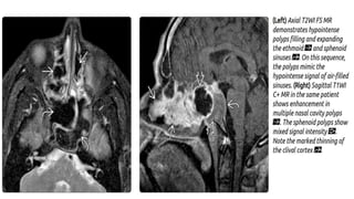 Radiological imaging in sinusitis.pptx