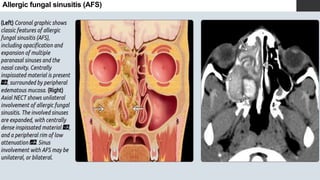 Radiological imaging in sinusitis.pptx