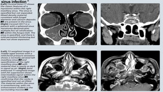 Radiological imaging in sinusitis.pptx