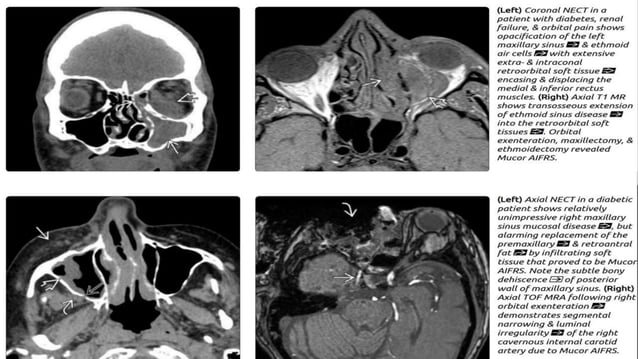 Radiological imaging in sinusitis.pptx