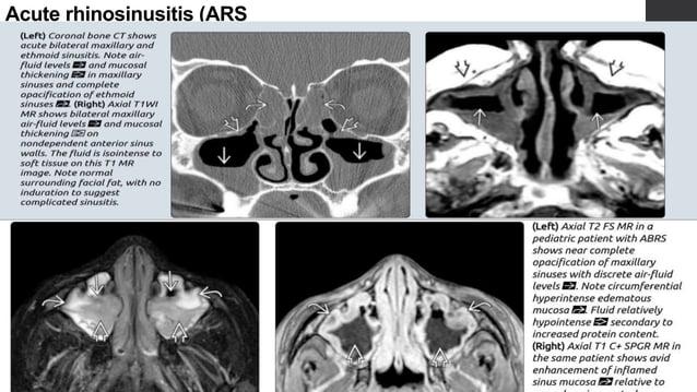 Radiological imaging in sinusitis.pptx