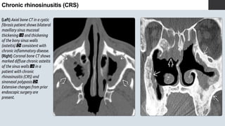 Radiological imaging in sinusitis.pptx
