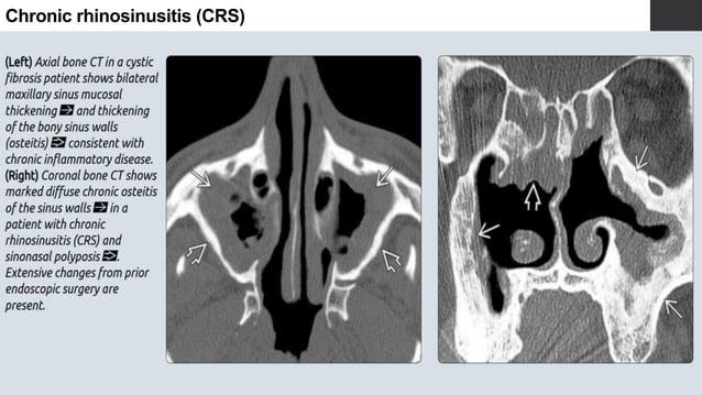 Radiological imaging in sinusitis.pptx