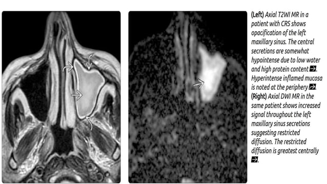 Radiological imaging in sinusitis.pptx