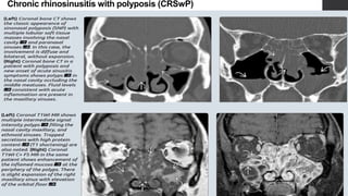 Radiological imaging in sinusitis.pptx