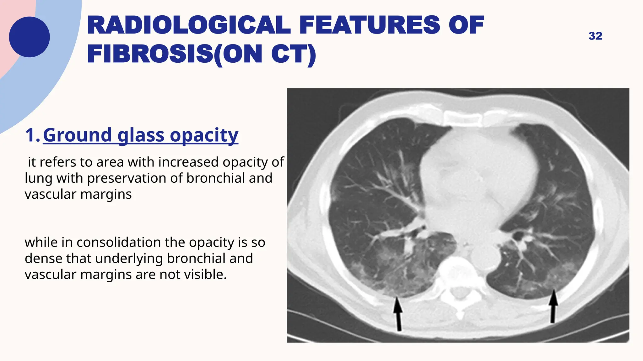 Radiological imaging of collapse vs consolidation vs fibrosis.pptx