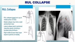 Radiological imaging of collapse vs consolidation vs fibrosis.pptx