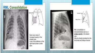 Radiological imaging of collapse vs consolidation vs fibrosis.pptx