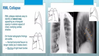 Radiological imaging of collapse vs consolidation vs fibrosis.pptx
