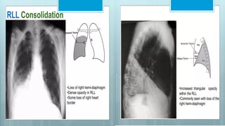 Radiological imaging of collapse vs consolidation vs fibrosis.pptx